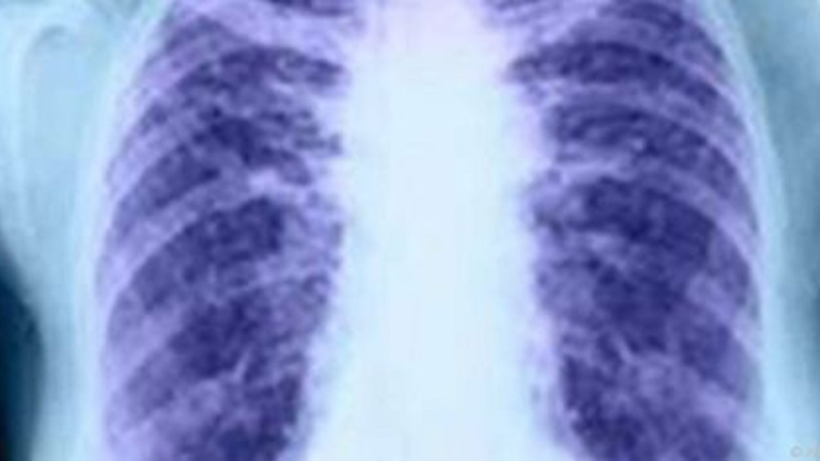 Therapieansatz für Karzinom-Komplikation entdeckt - gesund24.at