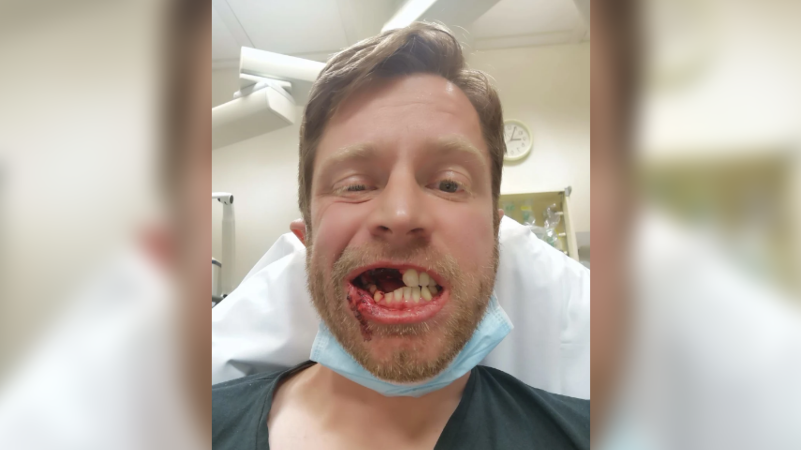 E-Zigarette explodiert im Mund - oe24.at