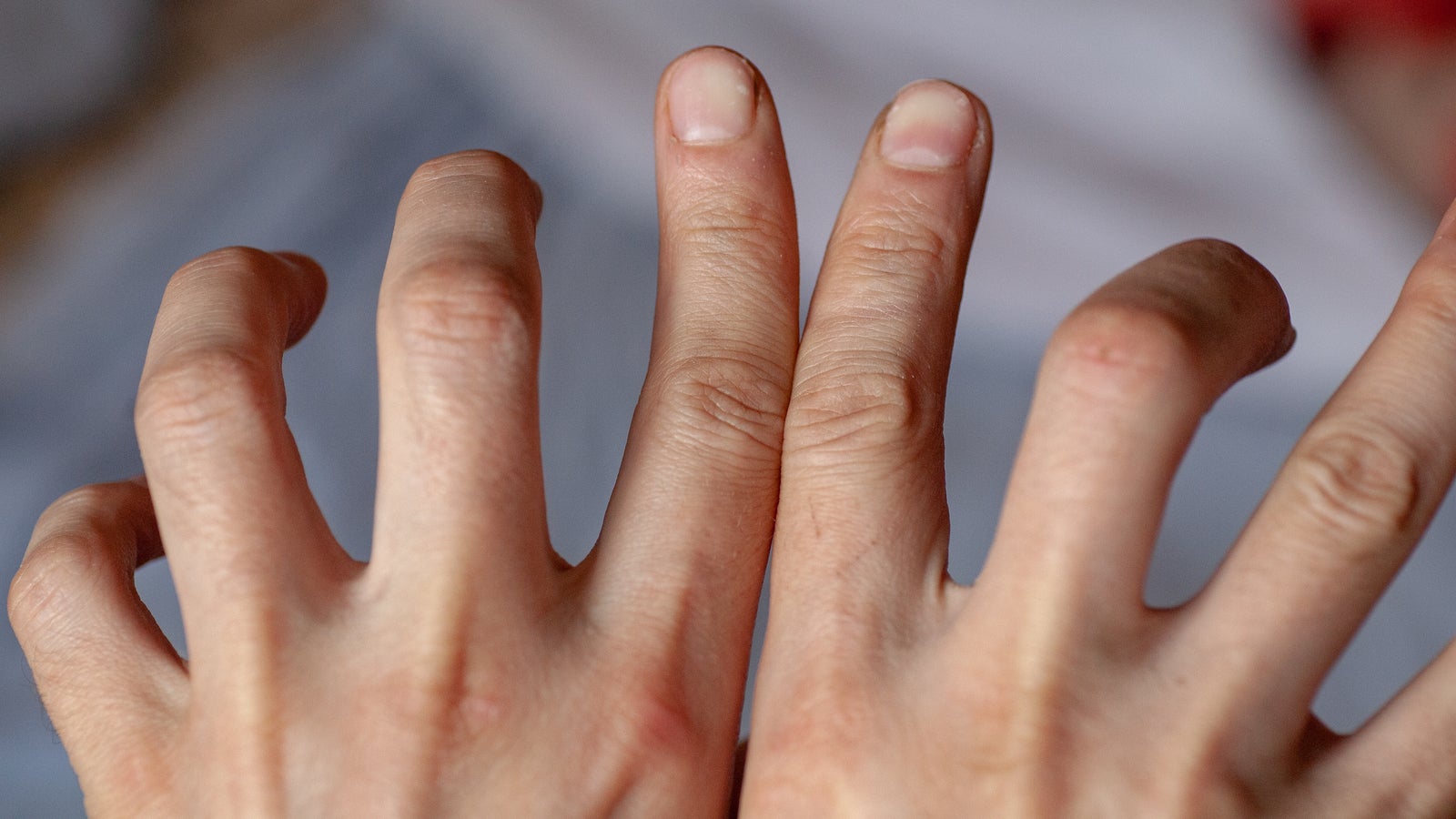 Wenn sich die Finger krümmen - gesund24.at